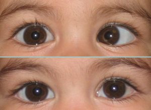 Pediatric | Eye Muscle Surgery | Sarasota, Bradenton, Florida | Coastal ...